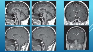 Spontaneous intracranial hypotension (sih) | PPTX