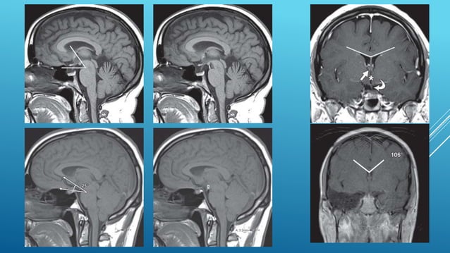Spontaneous intracranial hypotension (sih) | PPTX | Brain and Nervous ...