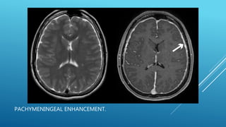 Spontaneous intracranial hypotension (sih) | PPTX