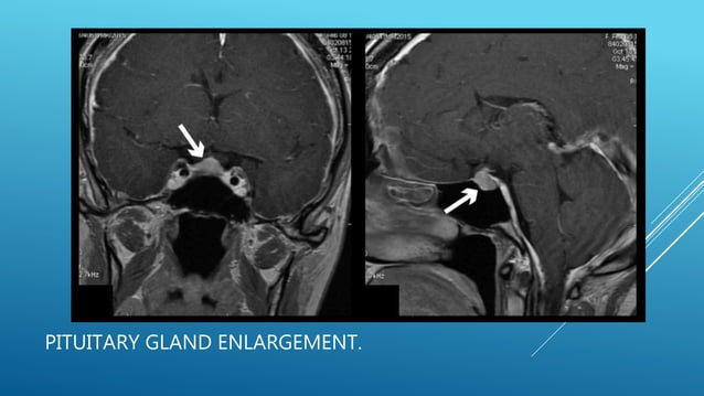 Spontaneous intracranial hypotension (sih) | PPTX | Brain and Nervous ...