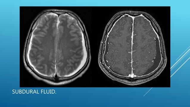 Spontaneous intracranial hypotension (sih) | PPTX | Brain and Nervous ...