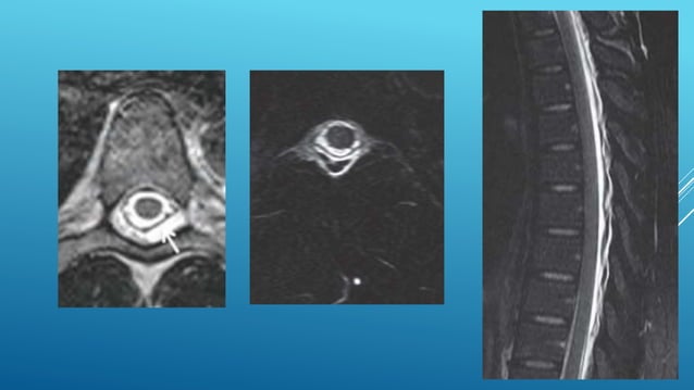 Spontaneous intracranial hypotension (sih) | PPTX | Brain and Nervous ...