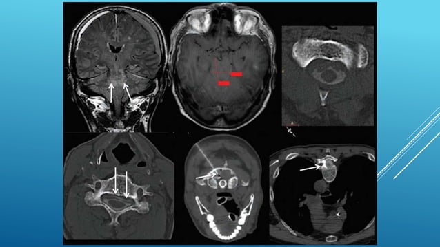 Spontaneous intracranial hypotension (sih) | PPTX | Brain and Nervous ...