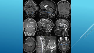 Spontaneous intracranial hypotension (sih) | PPTX | Brain and Nervous ...
