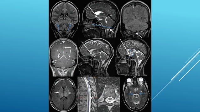 Spontaneous intracranial hypotension (sih) Spontaneous intracranial hypotension (sih)