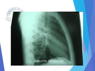 Spontaneously Expectorated Foreign Body.pdf