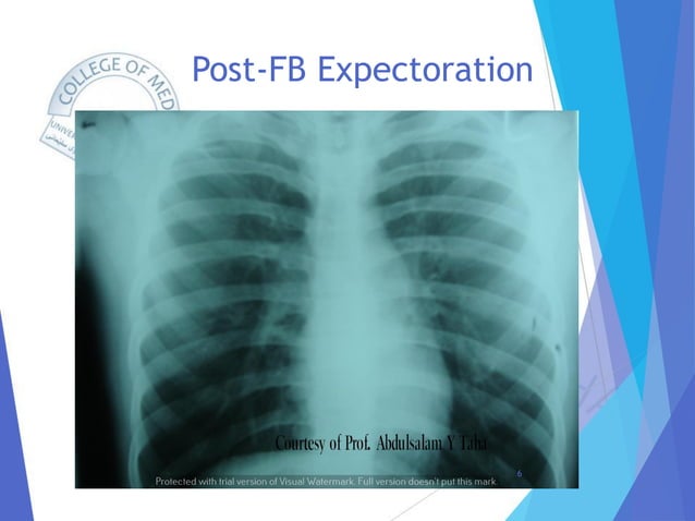 Spontaneously Expectorated Foreign Body.pdf