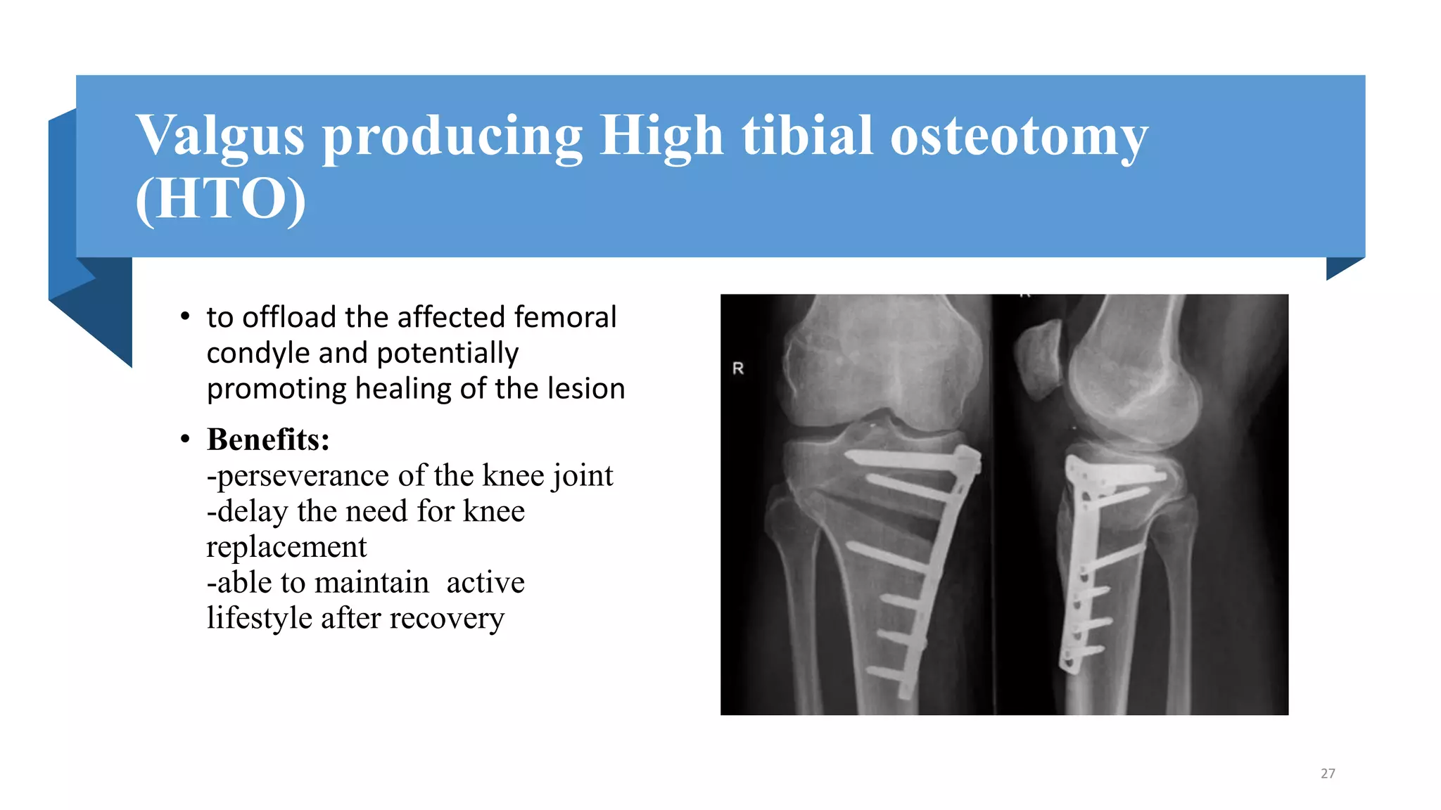 Spontaneous Osteonecrosis of the Knee.pptx