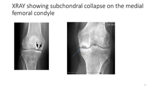 Spontaneous Osteonecrosis of the Knee.pptx