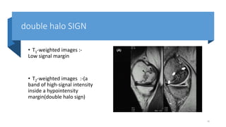 Spontaneous Osteonecrosis of the Knee.pptx