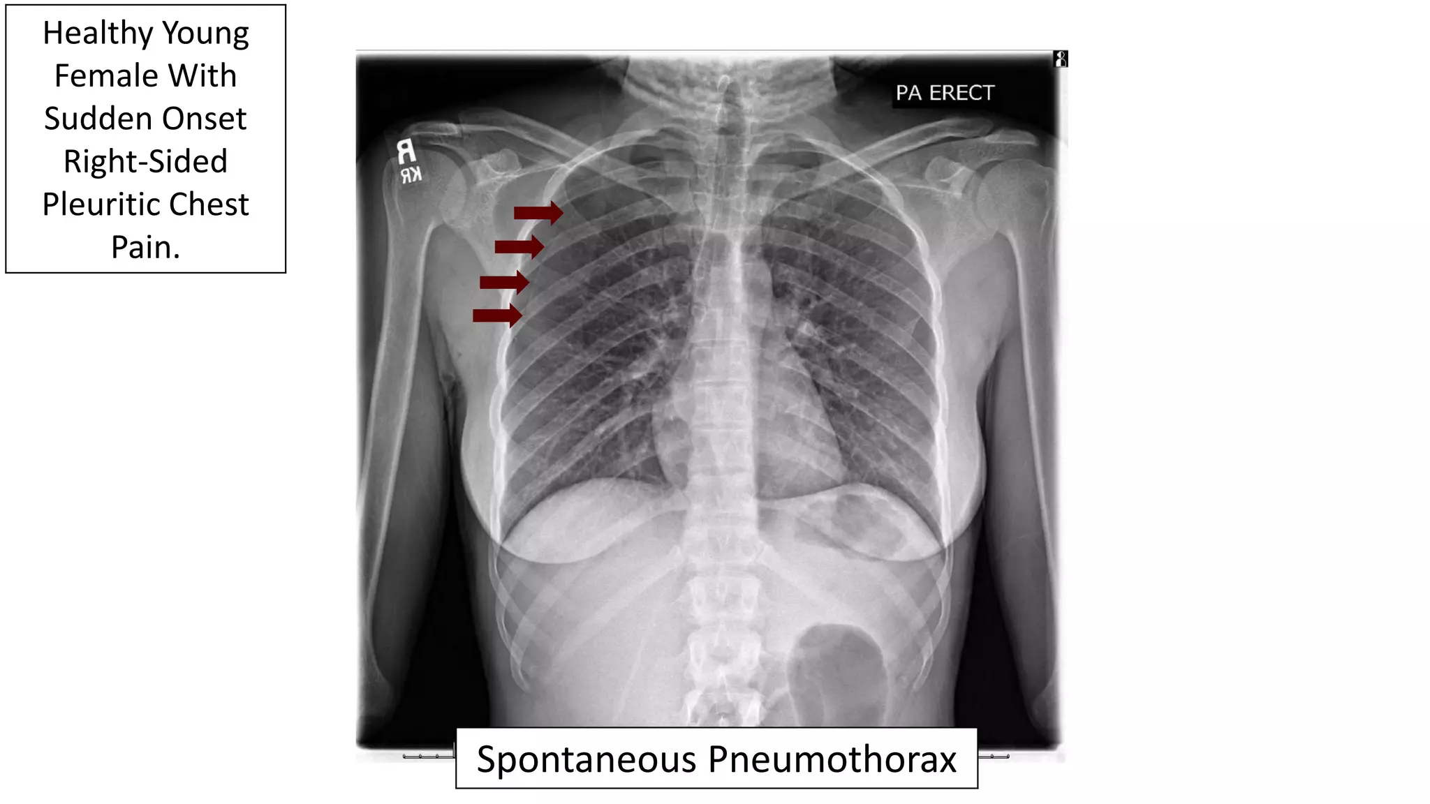 EMGuideWire's Radiology Reading Room: Spontaneous Pneumothorax | PPTX