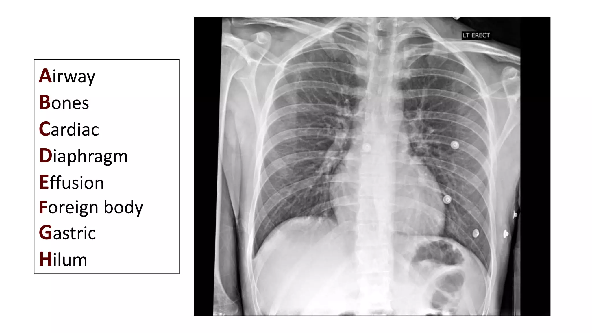 EMGuideWire's Radiology Reading Room: Spontaneous Pneumothorax | PPTX