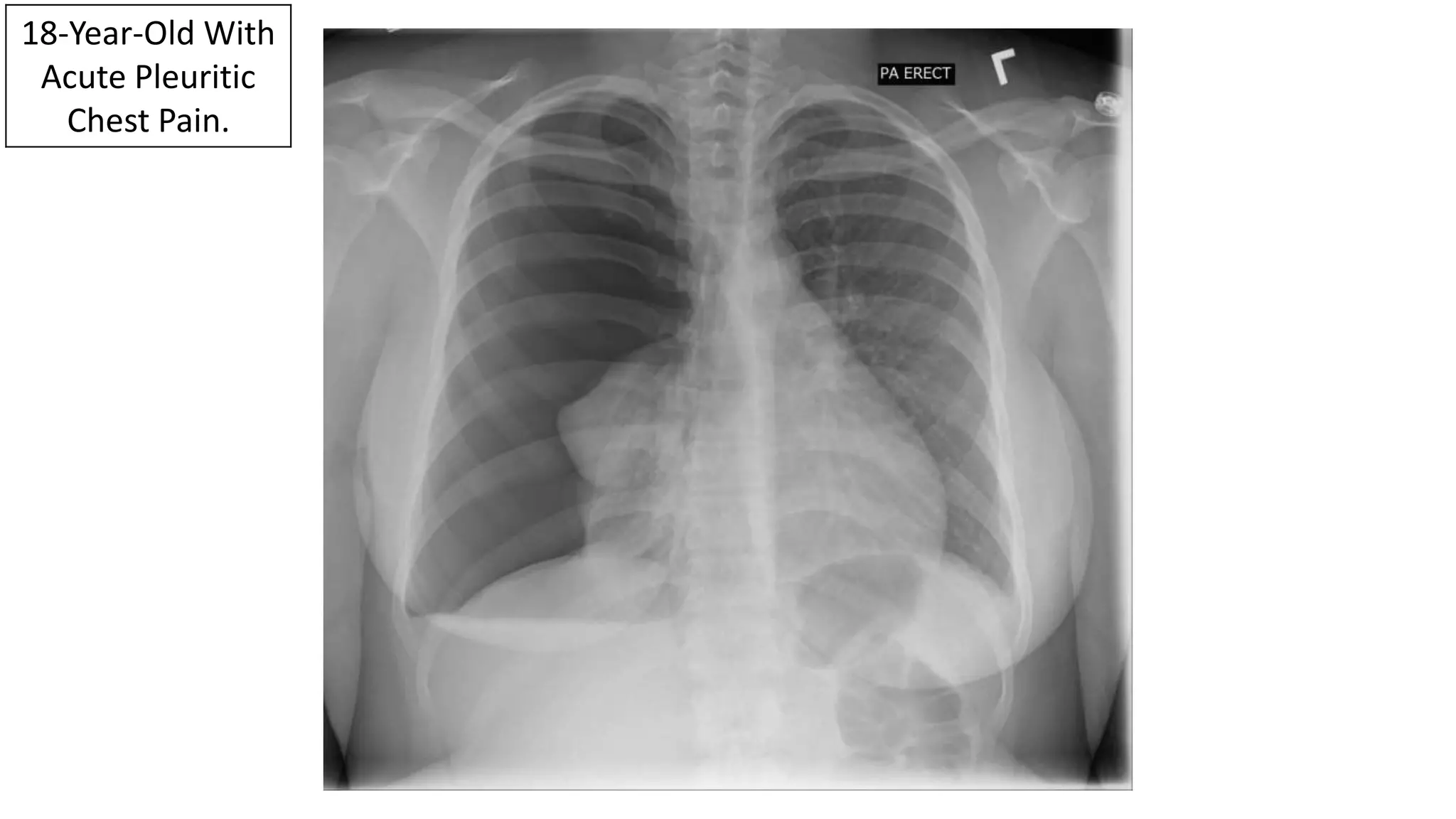 EMGuideWire's Radiology Reading Room: Spontaneous Pneumothorax | PPTX