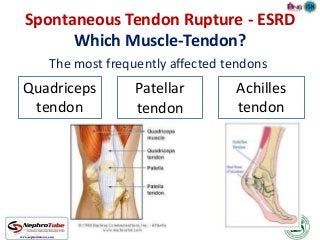 End Stage Renal Disease Patient With Spontaneous Tendo-Achilles Rupture ...