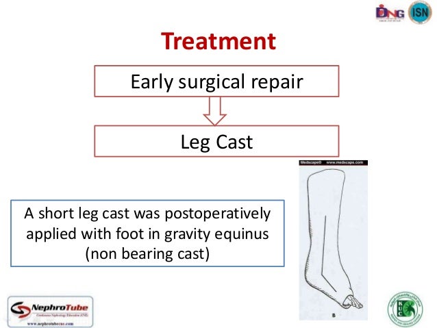 End Stage Renal Disease Patient With Spontaneous Tendo-Achilles Rupture ...