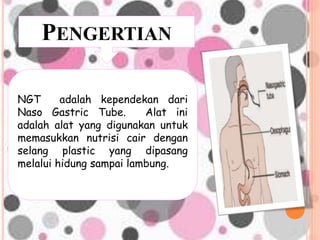 Prosedur Pemasangan NGT Yang Benar PDF, 47% OFF