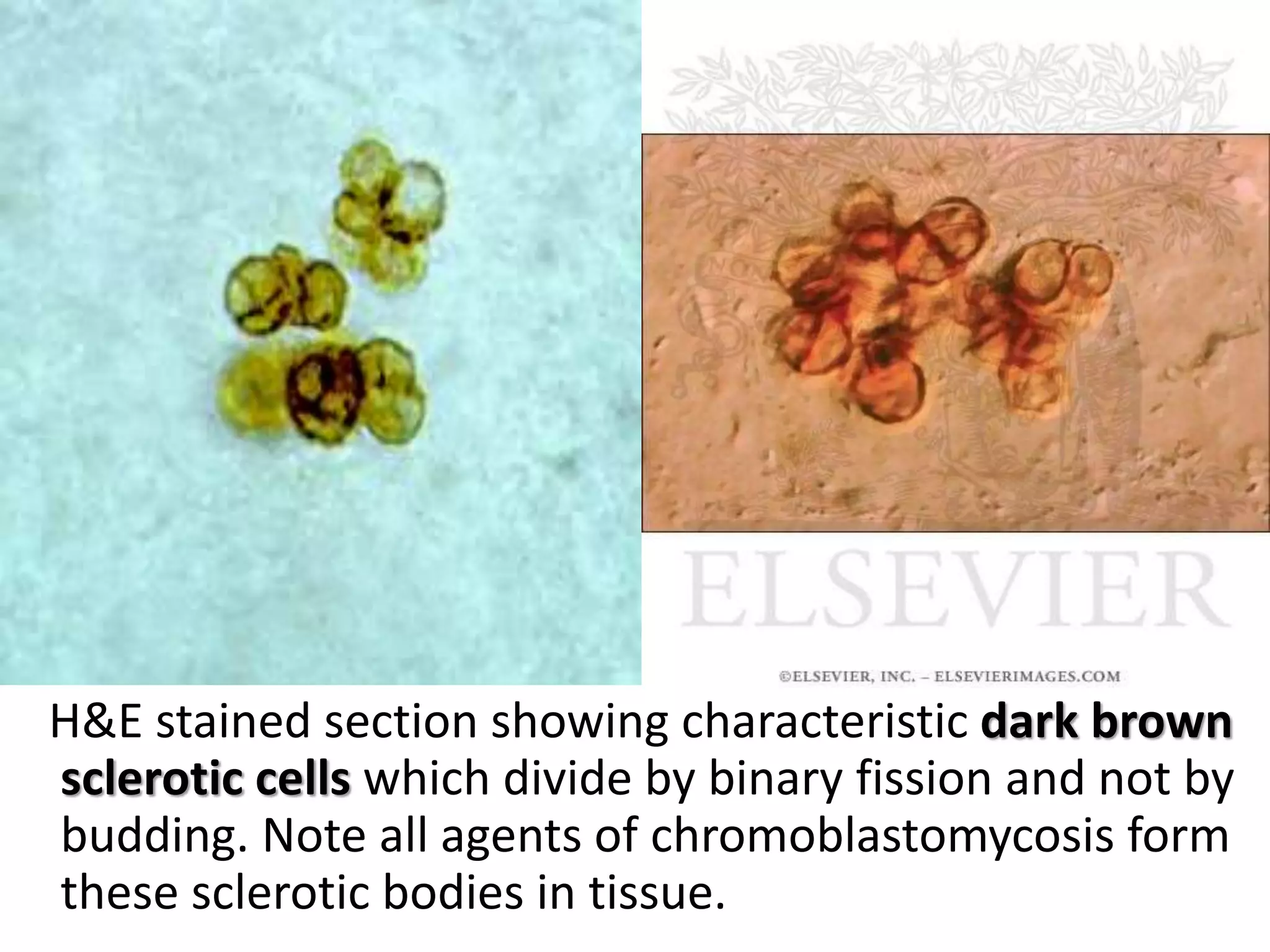 Sporotrichosis & chromoblatomycosis | PPTX