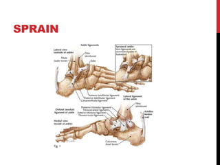 Sport injuries & prevention | PPTX