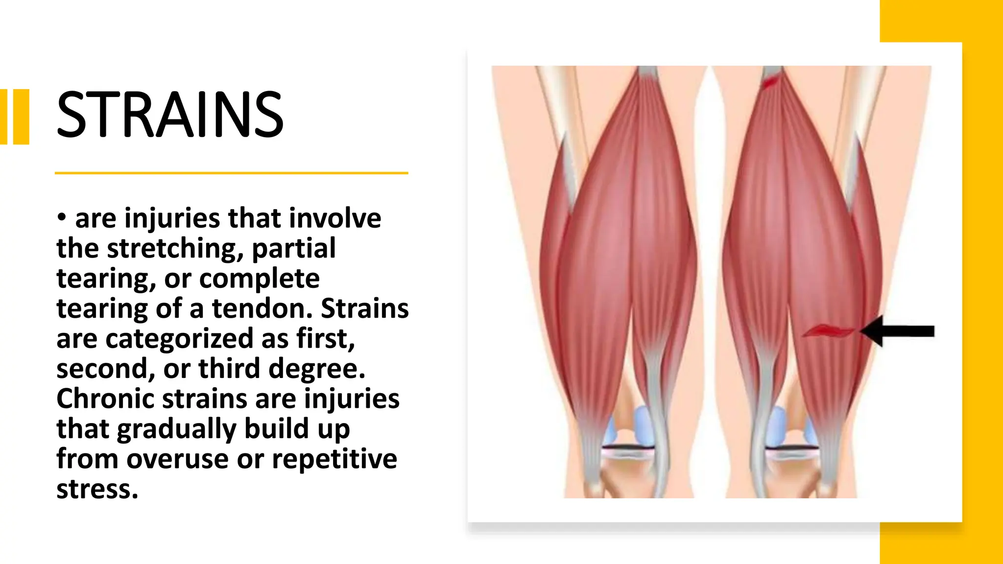 Sports-Related-Injuries-.pptxfrommapehgrade10 | PPTX | Death, Injury ...