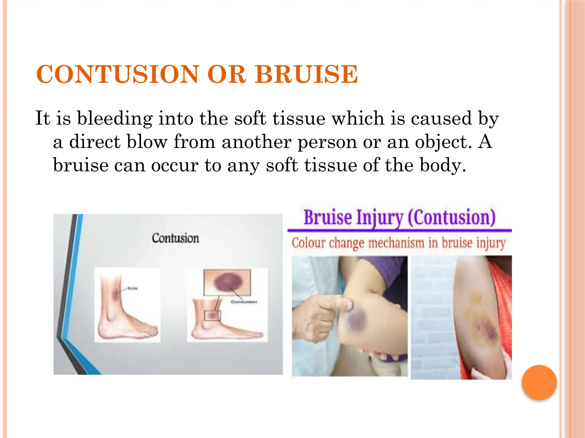 Sports Injuries and Prevention of Sports Injuries | PPTX