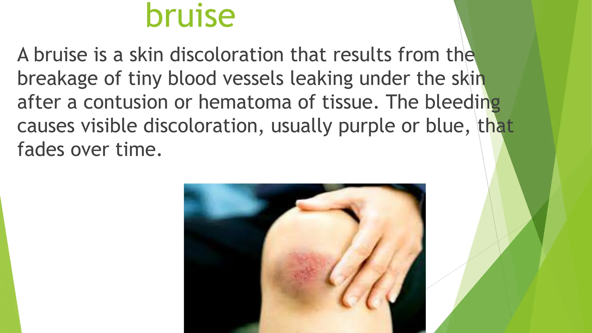 SPORTS INJURIES | PPTX