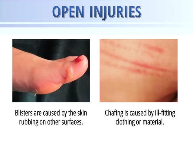 Sports Injury | PDF | Death, Injury, or Military Conflict | Sensitive ...