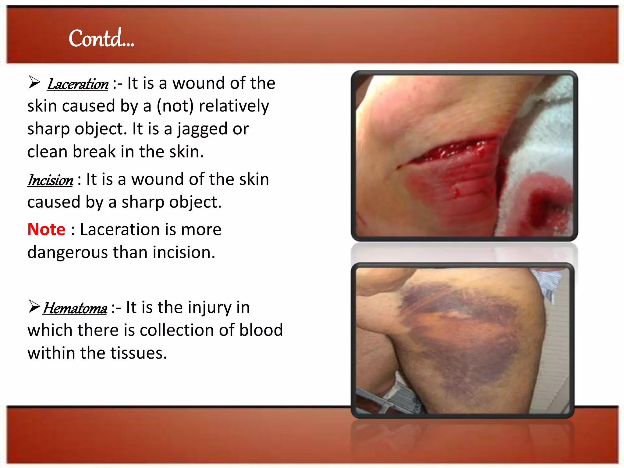 Sports Injury in Detail | PPTX