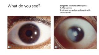 Spot Diagnosis - Look at the pictures-What do you See - Cornea.pptx
