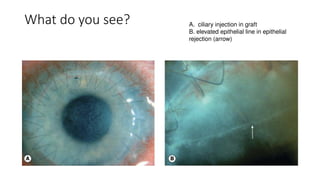 Spot Diagnosis - Look at the pictures-What do you See - Corneal and ...