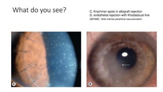 Spot Diagnosis - Look at the pictures-What do you See - Corneal and ...