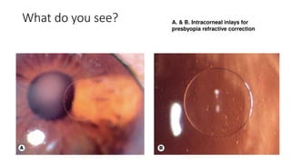 Spot Diagnosis - Look at the pictures-What do you See - Corneal and ...