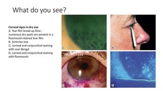 Spot Diagnosis - Look at the pictures-What do you See - Dry Eye.pptx