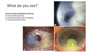 Spot Diagnosis - Look at the pictures-What do you See - Dry Eye.pptx