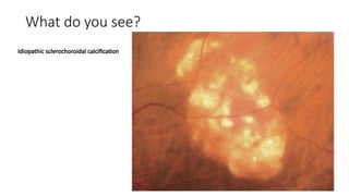 Spot Diagnosis - Look at the pictures-What do you See - Episclera and ...