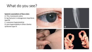 Spot Diagnosis - Look at the pictures-What do you See - Episclera and ...