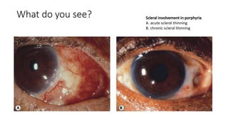 Spot Diagnosis - Look at the pictures-What do you See - Episclera and ...