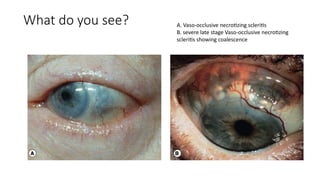 Spot Diagnosis - Look at the pictures-What do you See - Episclera and ...