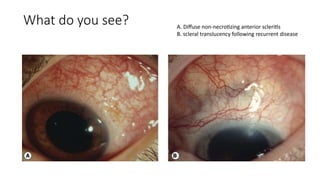 Spot Diagnosis - Look at the pictures-What do you See - Episclera and ...