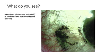 Spot Diagnosis - Look at the pictures-What do you See - Episclera and ...