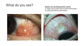 Spot Diagnosis - Look at the pictures-What do you See - Episclera and ...