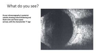 Spot Diagnosis - Look at the pictures-What do you See - Episclera and ...