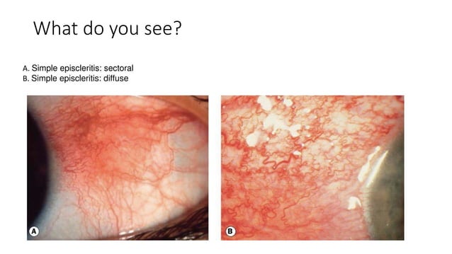 Spot Diagnosis - Look at the pictures-What do you See - Episclera and ...