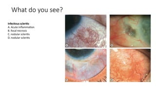 Spot Diagnosis - Look at the pictures-What do you See - Episclera and ...