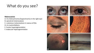 Spot Diagnosis - Look at the pictures-What do you See - Episclera and ...