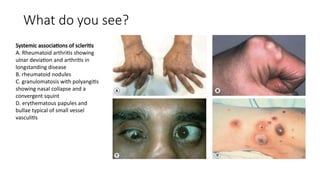 Spot Diagnosis - Look at the pictures-What do you See - Episclera and ...