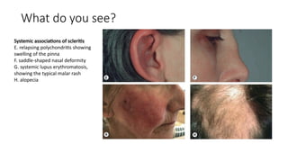 Spot Diagnosis - Look at the pictures-What do you See - Episclera and ...