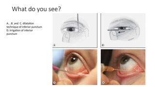 Spot Diagnosis - Look at the pictures-What do you See - Lacrimal ...