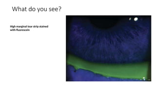 Spot Diagnosis - Look at the pictures-What do you See - Lacrimal ...