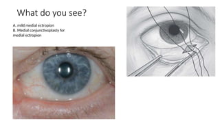 Spot Diagnosis - Look at the pictures-What do you See - Lacrimal ...