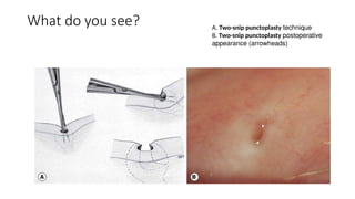 Spot Diagnosis - Look at the pictures-What do you See - Lacrimal ...